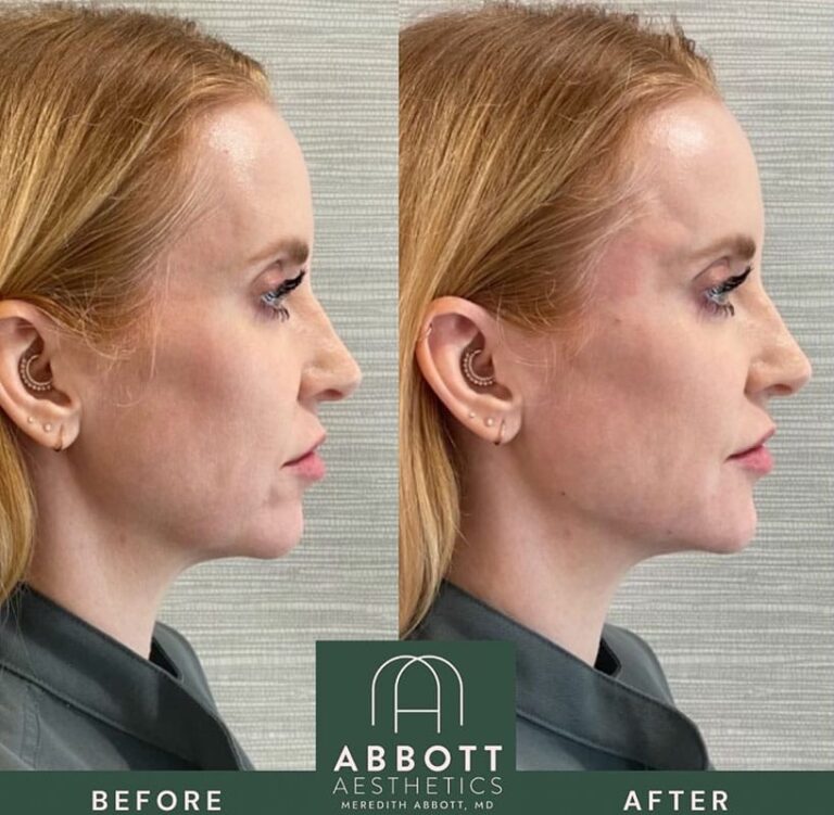Chin & Cheek Enhancement in Dallas, TX | Abbott Aesthetics