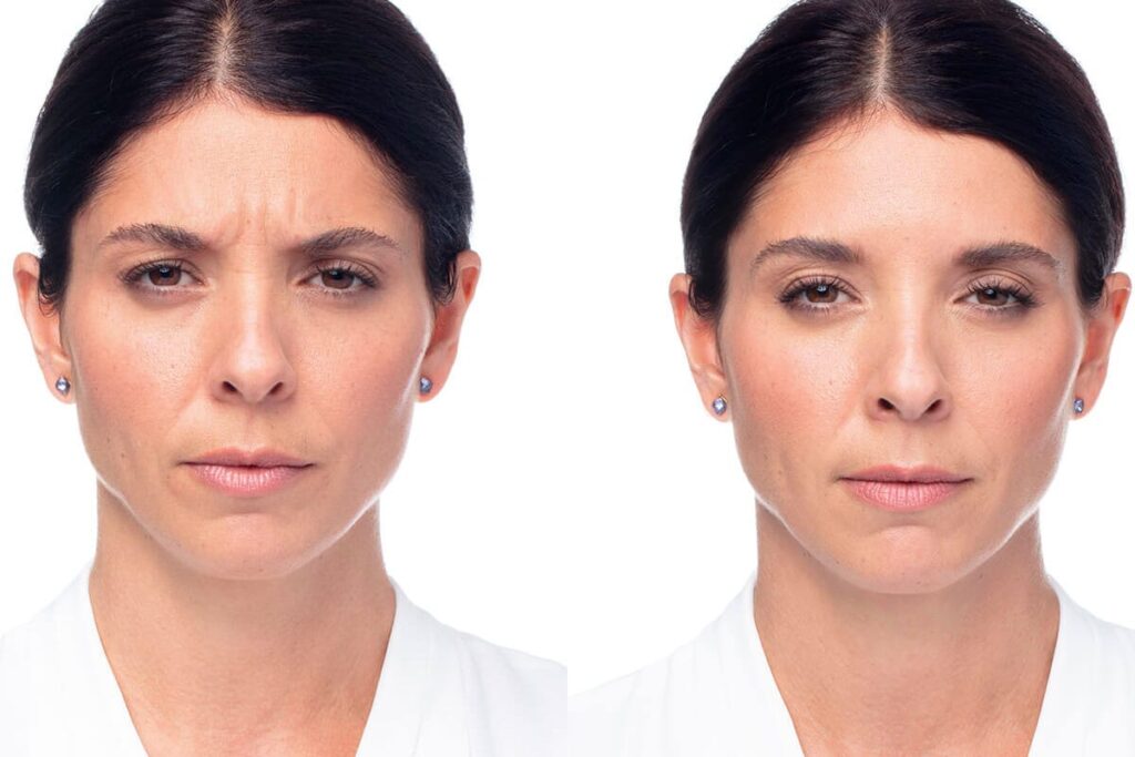 Neuromodulators | Abbott Aesthetics