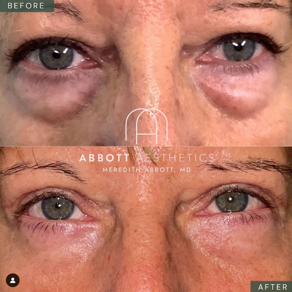 Lower Blepharoplasty in Dallas, TX | Abbott Aesthetics